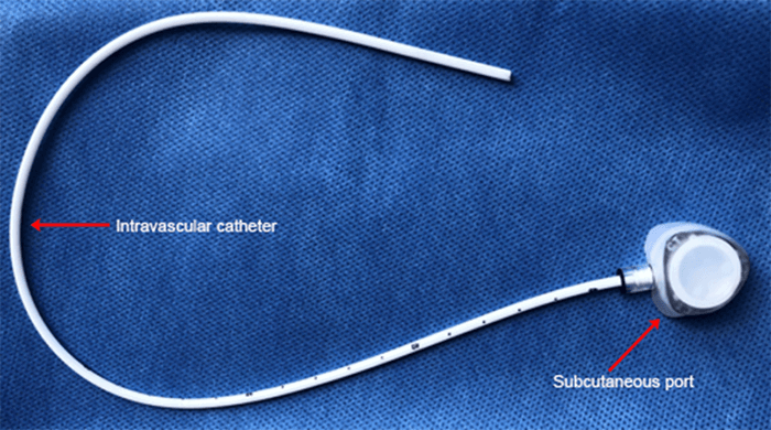 Management Strategies for Totally Implantable Venous Access Devices Not ...