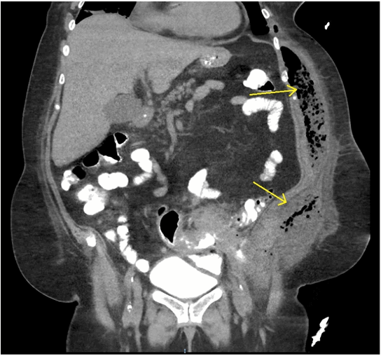 A Rare Case of Sigmoid Adenocarcinoma Presenting with Coloenteric ...