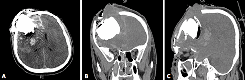 Management of an Undetonated Intracranial Explosive: A Multi ...