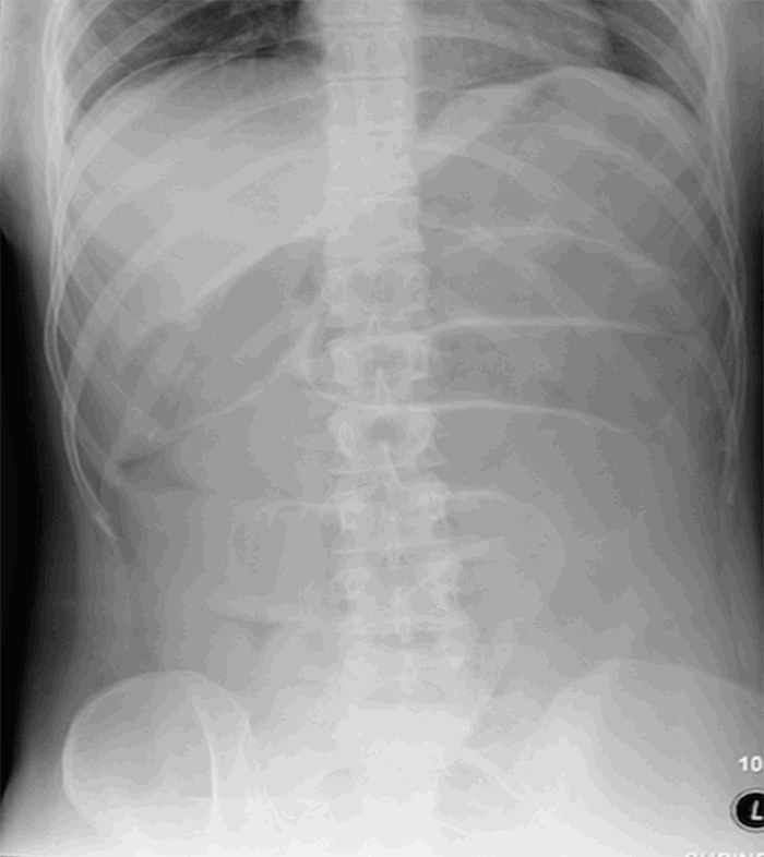 Fulminant Clostridium difficile Small Bowel Enteritis in a 23-Year-Old ...