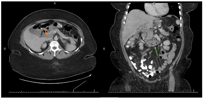 Extensive Portomesenteric Venous Thrombosis after Laparoscopic Sleeve ...