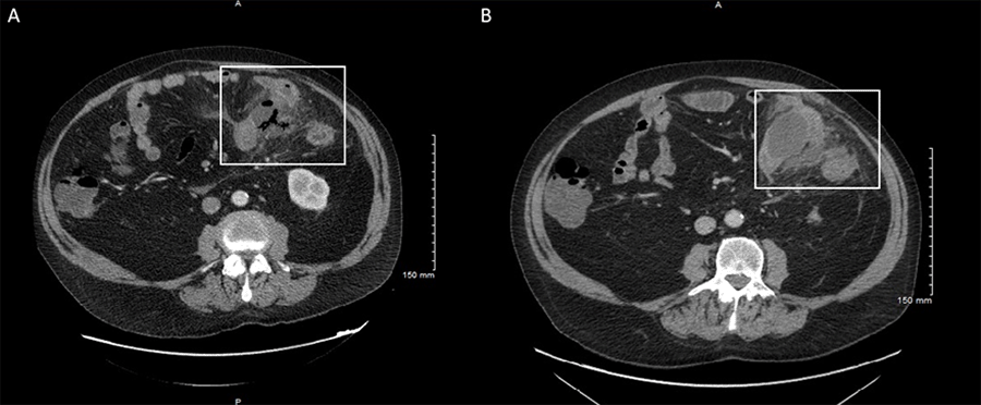 Post-Recovery Complications of Gastrointestinal Abscesses and ...