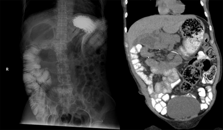 Duodenal Atresia, Intestinal Malrotation, and Gastrojejunal ...