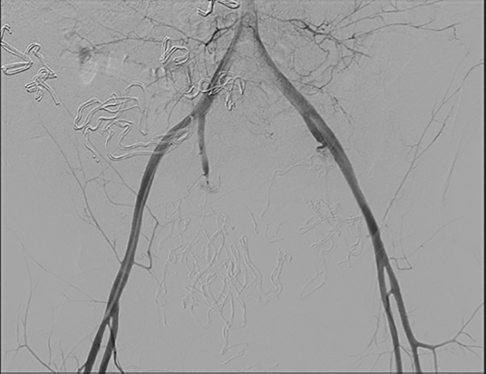 Vesico-cutaneous Fistula: A Rare Complication of Complex Pelvic Trauma ...