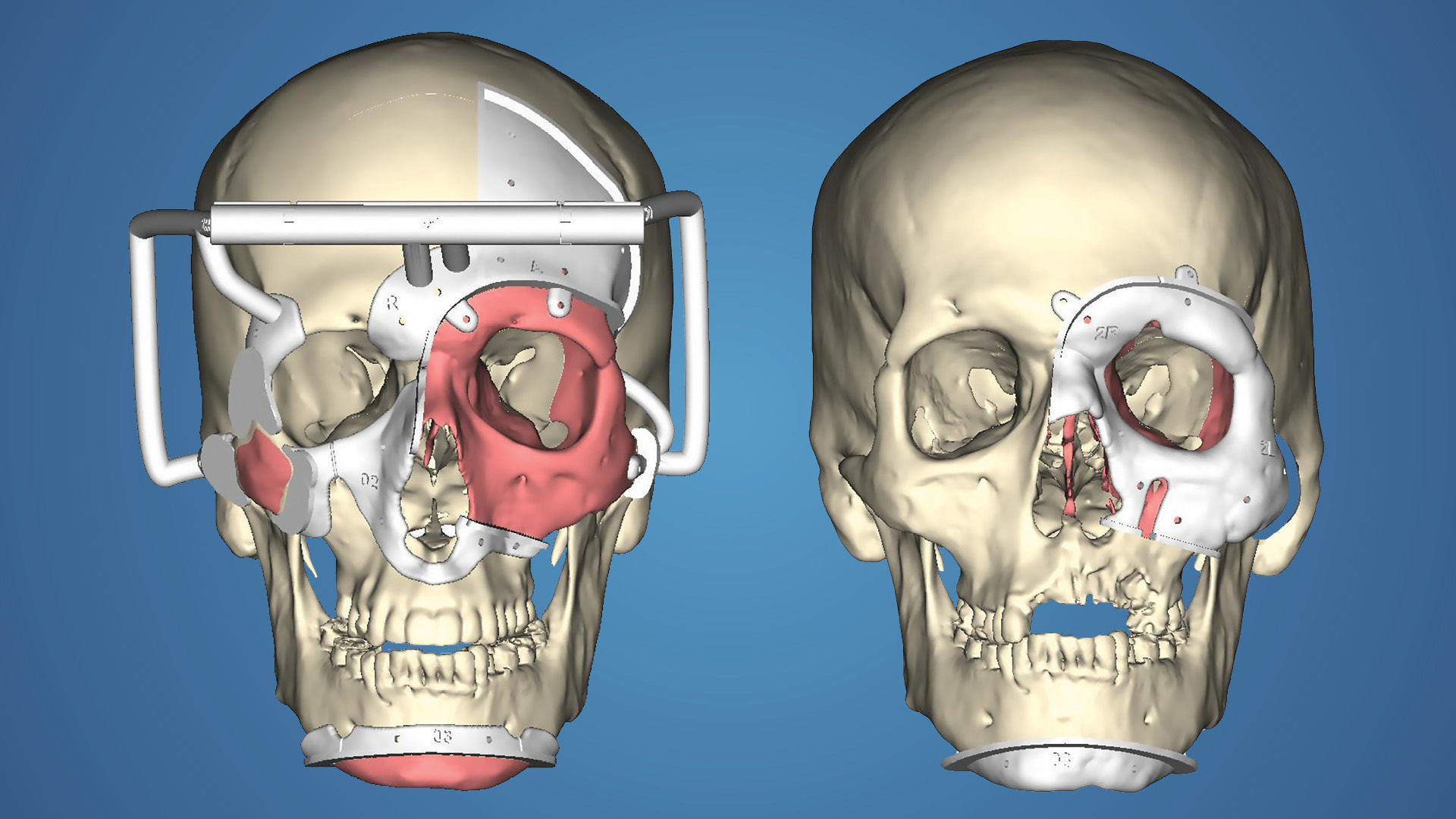 Facial Transplantation Pushes Beyond Limits of Reconstruction | ACS
