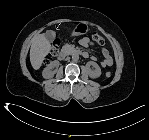 Mixed Neuroendocrine Non-Neuroendocrine Neoplasm of the Gallbladder | ACS