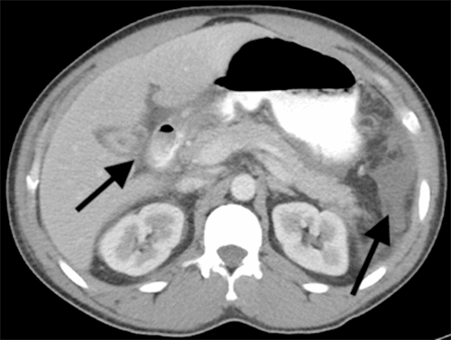 Delayed Presentation of Isolated Traumatic Gallbladder Rupture with ...