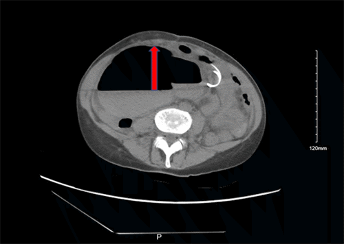 Gastroparesis Presenting with a Rare Case of Mechanical Bowel ...