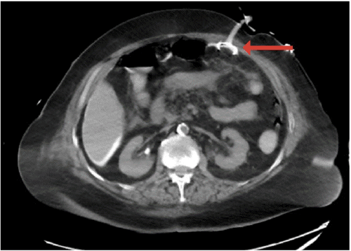 Unclear Etiology of Early Percutaneous Endoscopic Gastrostomy Tube ...