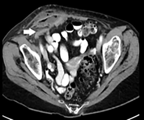Amyand’s Hernia and Complicated Appendicitis Presenting as an Abdominal ...