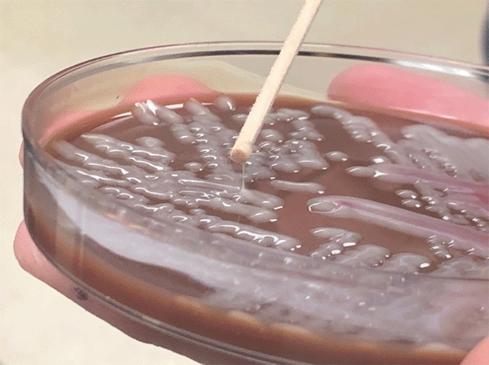 Laparoscopic-assisted Percutaneous Drainage of Hepatic Abscesses Caused ...