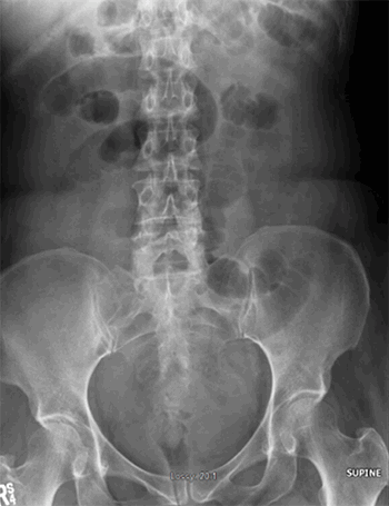 Indocyanine Green Fluorescence-Guided Laparoscopic Cholecystectomy with ...