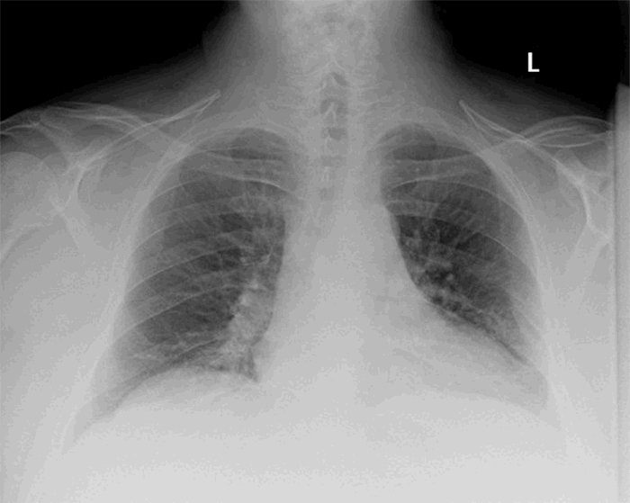Hyperkinetic Biliary Dyskinesia in Adults: Cholecystectomy as a ...