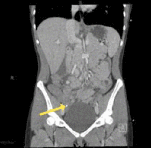 Beyond the Obvious: Appendiceal Endometriosis Presenting as Acute ...
