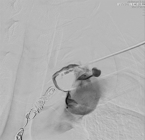 Repeat Thoracic Duct Embolization in Traumatic Thoracic Duct Injury: An ...