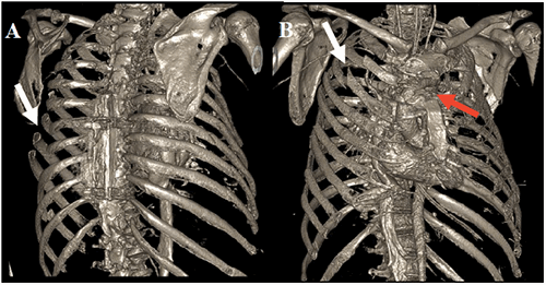 Surgical Stabilization of Rib Fractures Alleviates Debilitating Axial ...