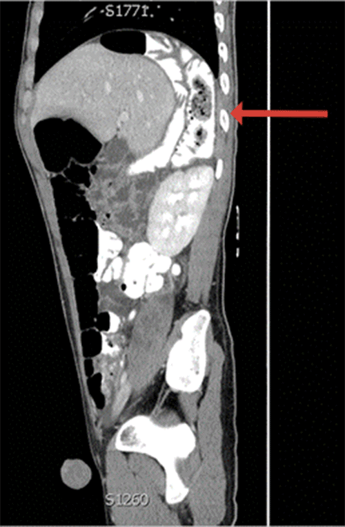 Surgical Management of Chilaiditi Syndrome with Gastric Outlet ...