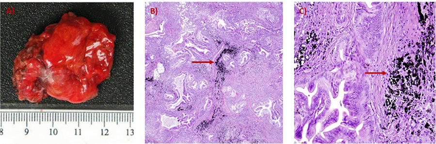 Peritoneal Recurrence of Early-Stage Gastric Cancer With Associated ...