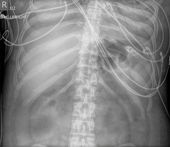 Colonic Paralytic Ileus in COVID-19 Patients | ACS