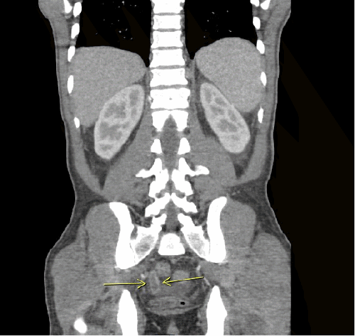 Acute Tip Appendicitis in the Setting of Newly Diagnosed Adult T-Cell ...
