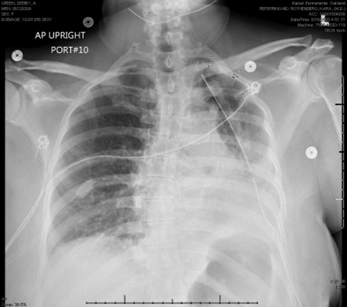 Left Lower Torsion Following Lobectomy, Successfully Managed with ...