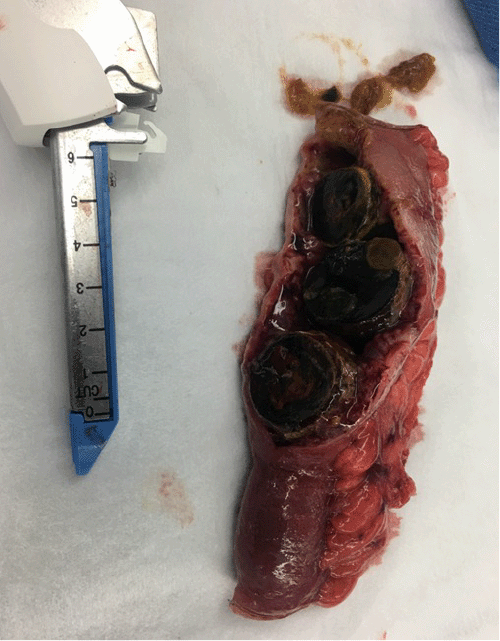 A Rare Case of Recurrent Gallstone Ileus | ACS
