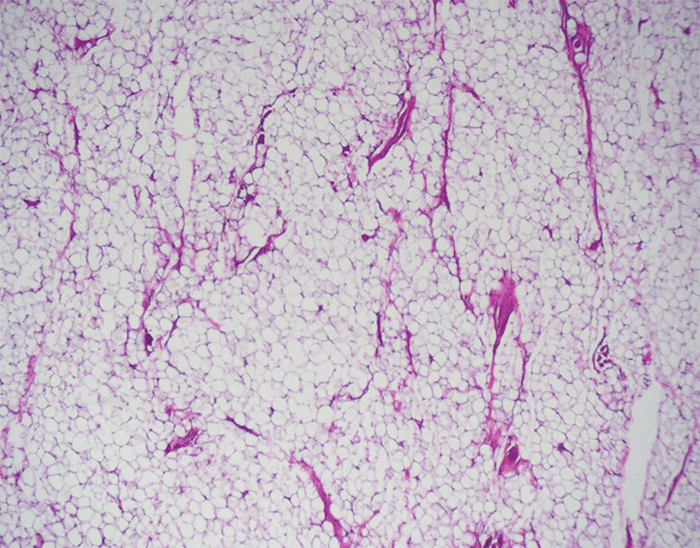 Lipoma of the Finger with Neurovascular Bundle Divergence | ACS