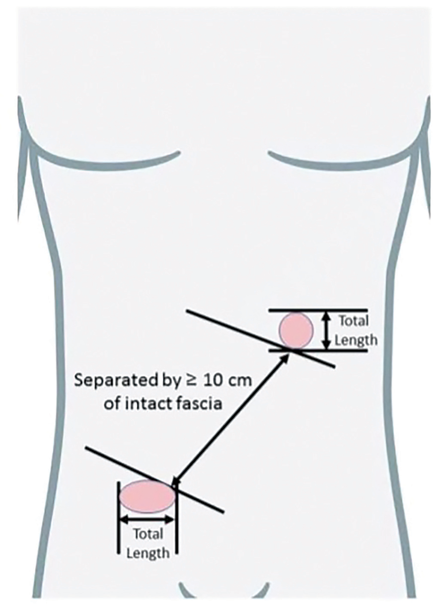 Coming in 2023: Extensive Changes for Reporting Anterior Abdominal Hernia Repair | ACS