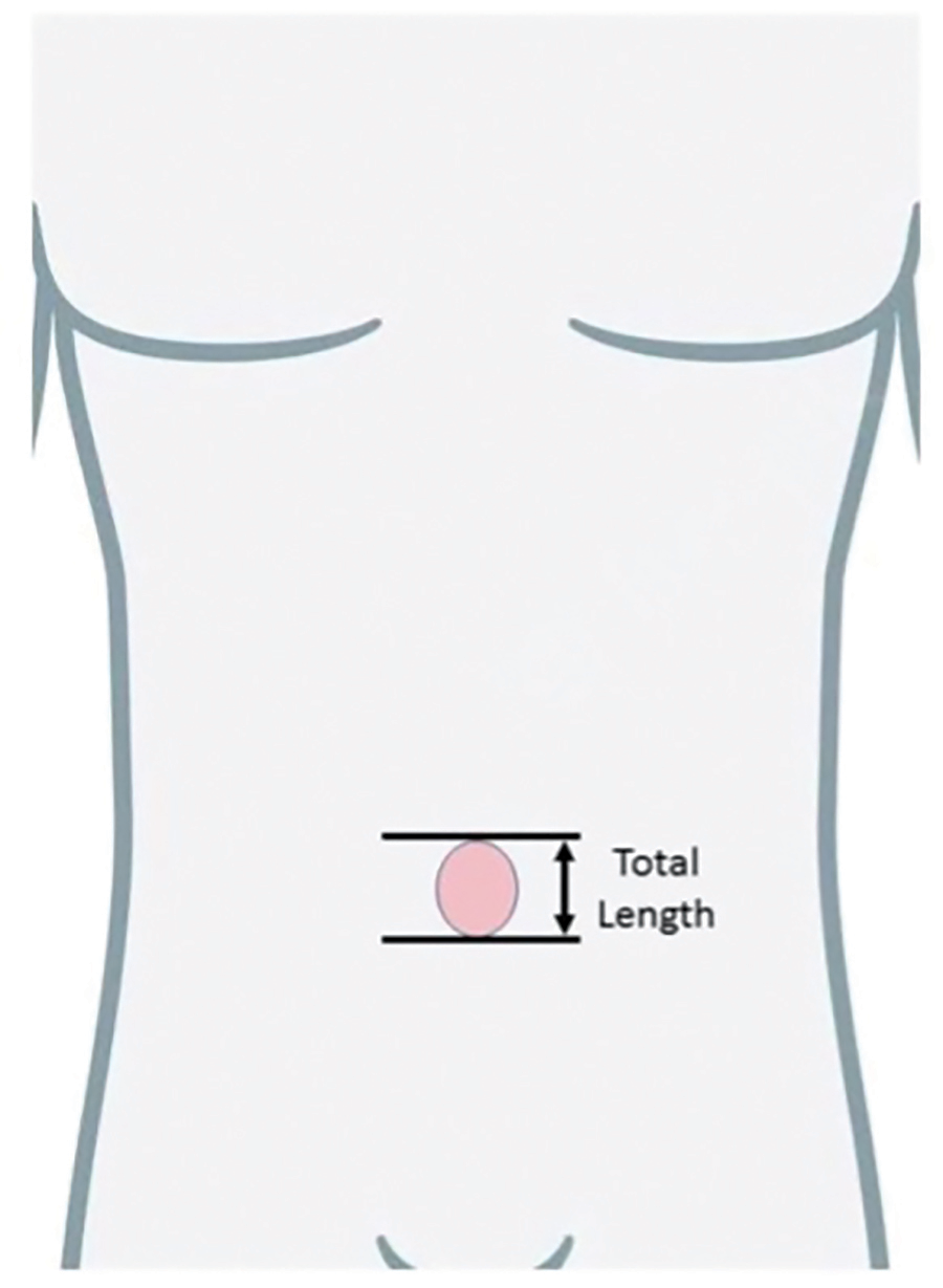 Coming in 2023: Extensive Changes for Reporting Anterior Abdominal ...