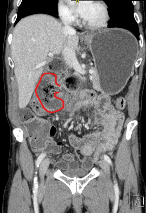 Giant Perforated Duodenal Diverticulum Management | ACS
