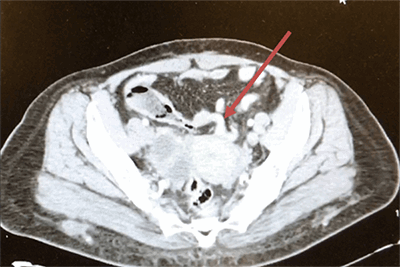 48-Year-Old Female Presents with Intestinal Malrotation and Acute ...
