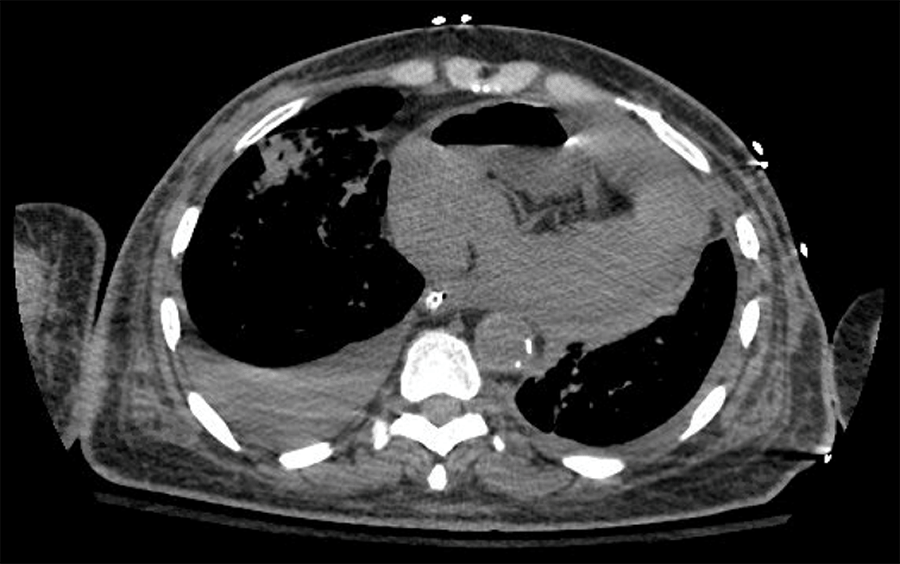 Parietopericardial Hernia with Small Bowel Strangulation ...