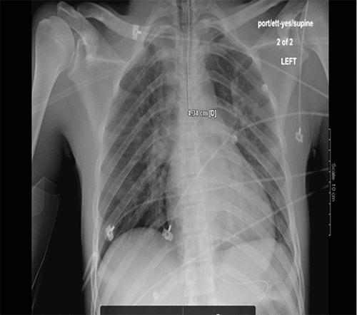 A Systematic Review of Neurogenic Pulmonary Edema in Traumatic Brain ...
