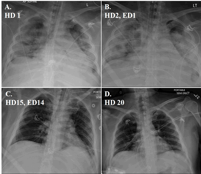 Rendezvous Procedure as an Alternative Treatment Strategy for Type C ...