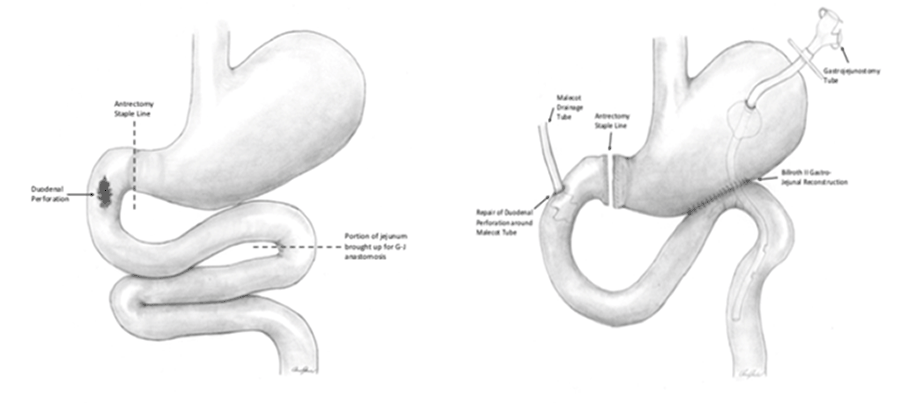 Delayed Presentation of a Duodenal Perforation After Blunt Abdominal Trauma | ACS
