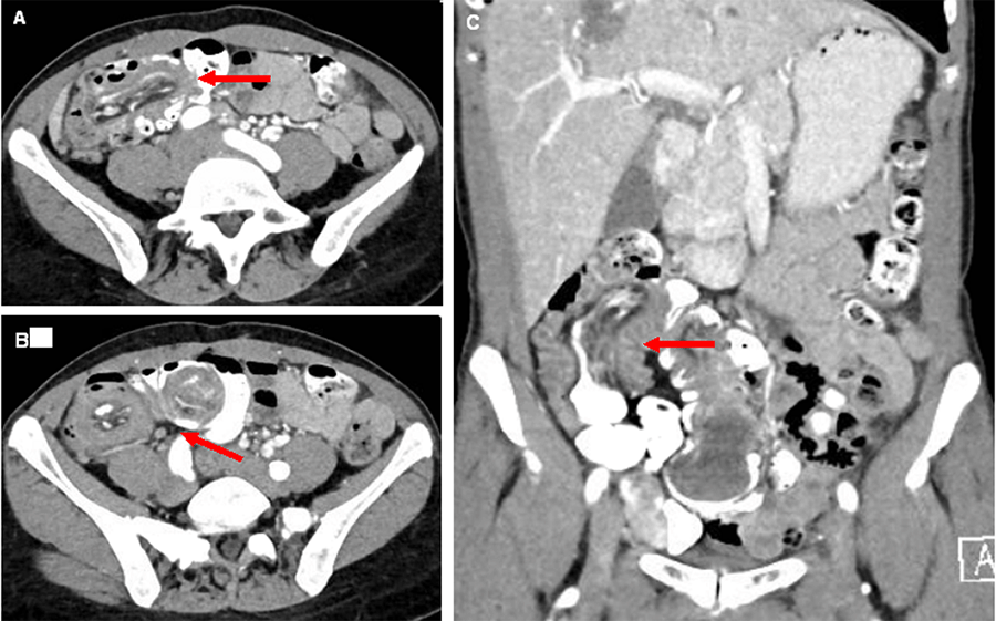Exercise-Induced Abdominal Pain: A Rare Case of Benign Adult Ileocolic ...