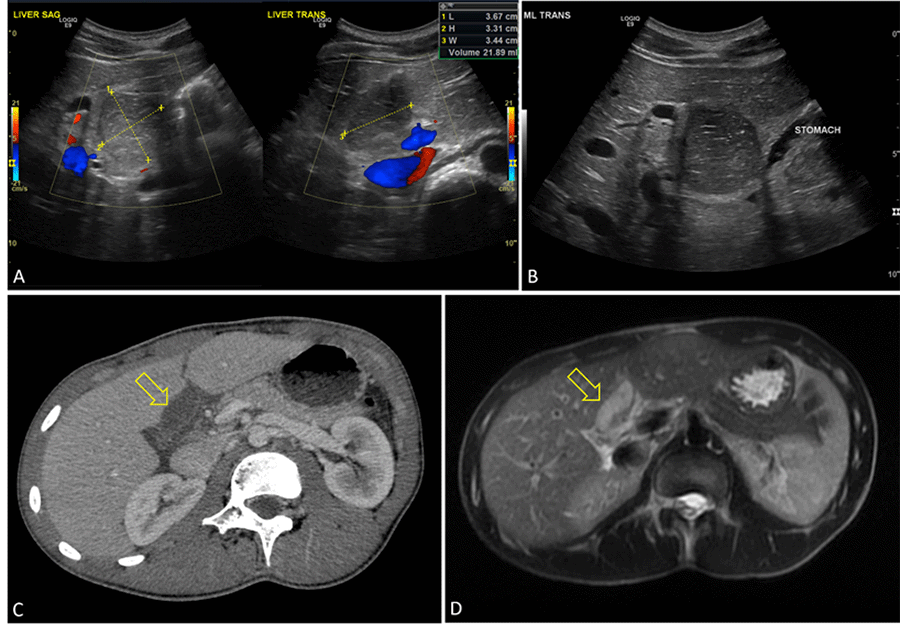 Torsion of a Mesenchymal Hamartoma in an Accessory Liver | ACS