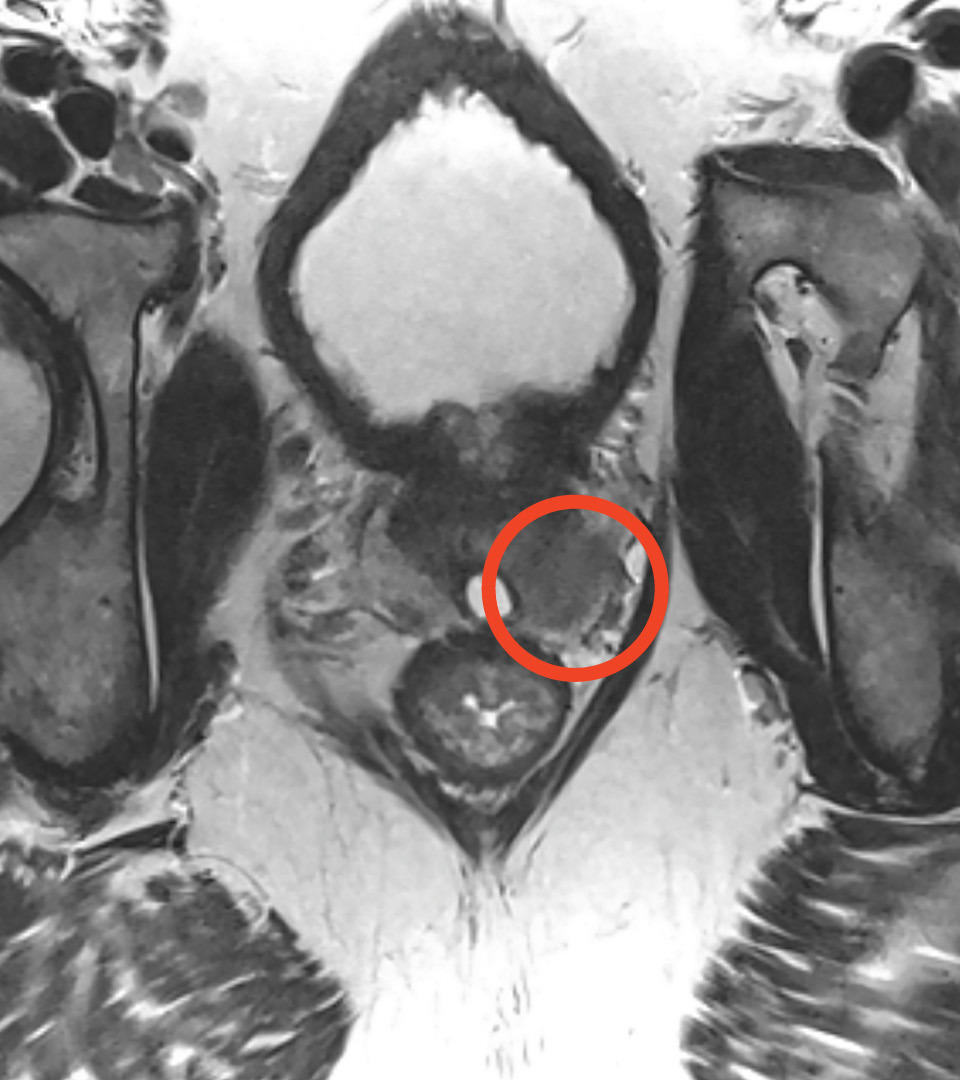 Advanced Imaging, Robotic Surgery Propel Prostate Cancer Management | ACS