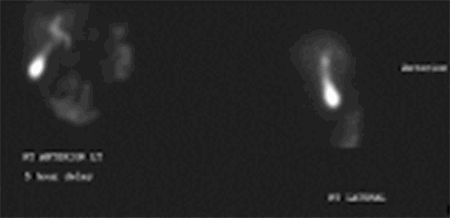 Abnormal Gallbladder Hida Scan Results