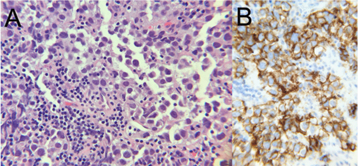 The Chamberlain Procedure to Diagnose Primary Mediastinal Seminoma ...