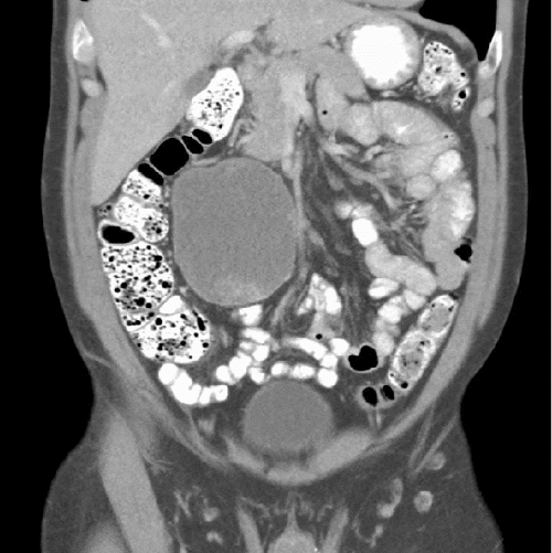 A Complex Intra-Abdominal Epidermoid Cyst: Pancreatic-Duodenal ...