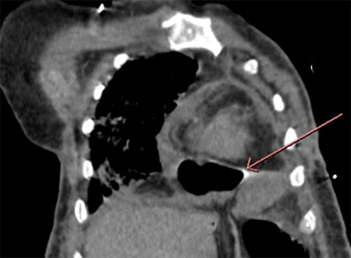 Parietopericardial Hernia with Small Bowel Strangulation ...