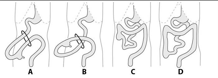 Absence of Ascending Colon, Persistent Transverse Colon, and Highly ...