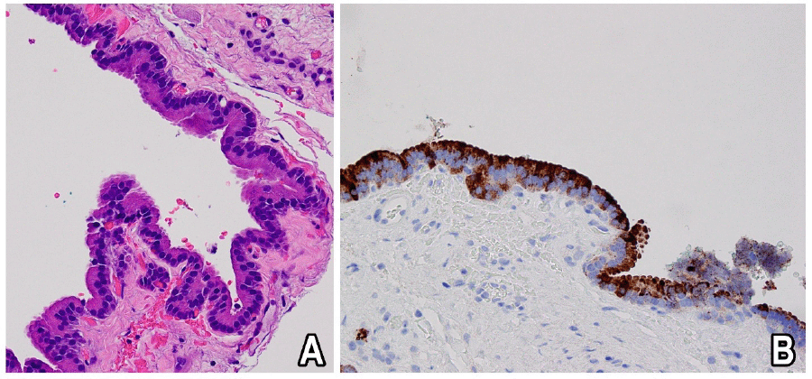 Acinar Cell Cystadenoma of the Pancreas: A Diagnostic Dilemma | ACS