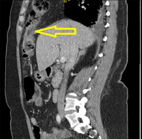 Incarcerated Morgagni Hernia Presenting after Robotic-Assisted ...