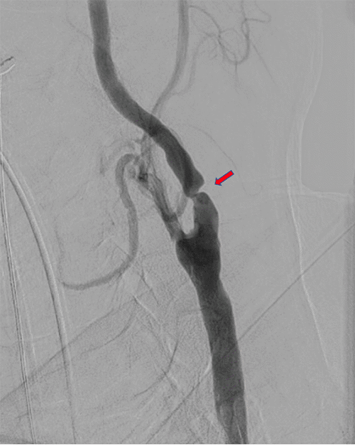 Binocular Amaurosis Fugax Treated with Staged Bilateral Transcarotid ...