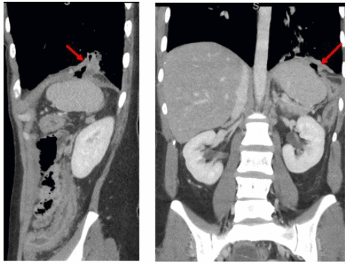 Colobronchial Fistula: When Inflammatory Bowel Disease and Traumatic ...