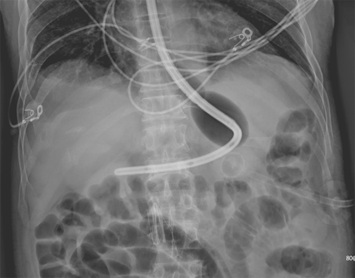 Minnesota Tube Utility in Non-Variceal Distal Esophageal Hemorrhage ...