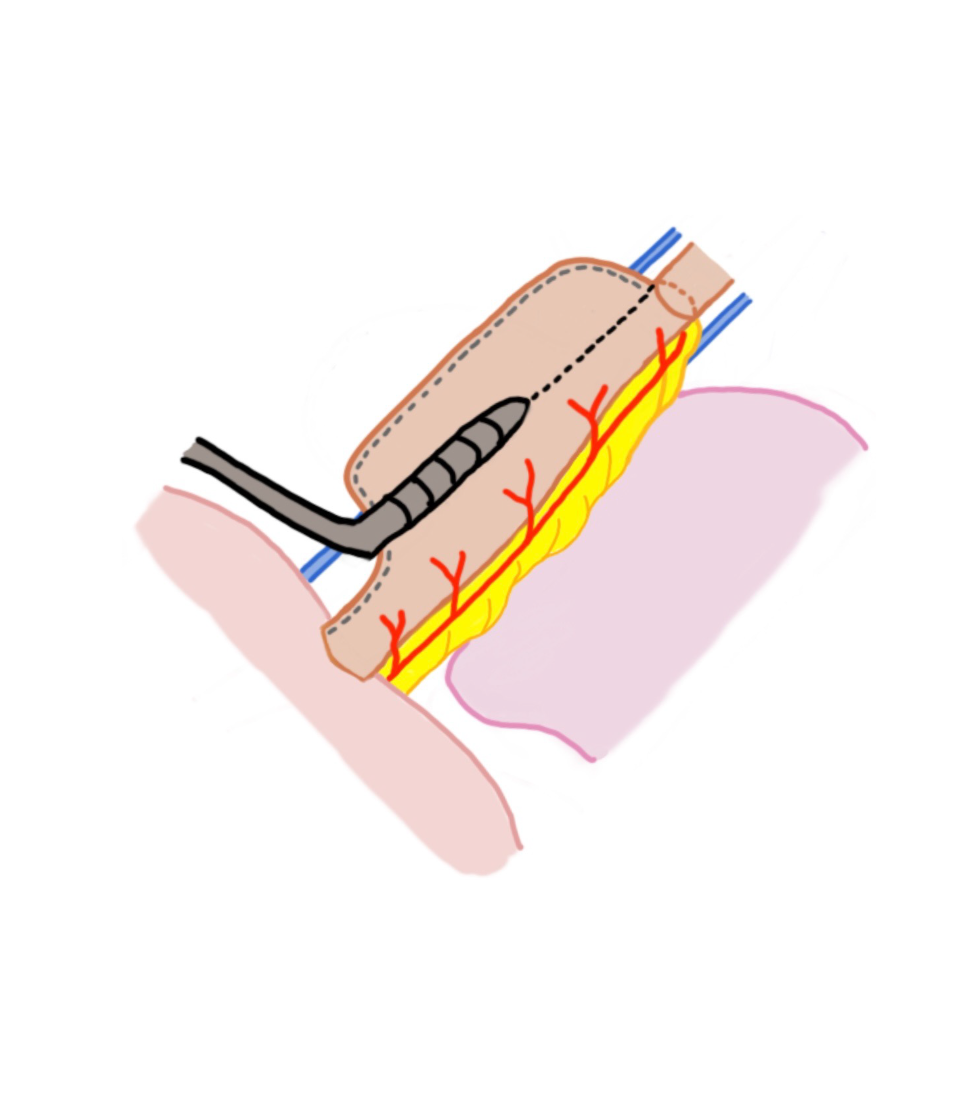 Surgeons Are Humanizing the Esophagectomy | ACS