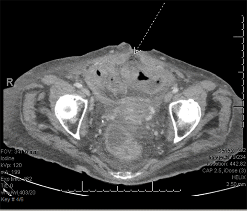 Acute Colocutaneous Fistula Management by Endoscopic Placement of ...